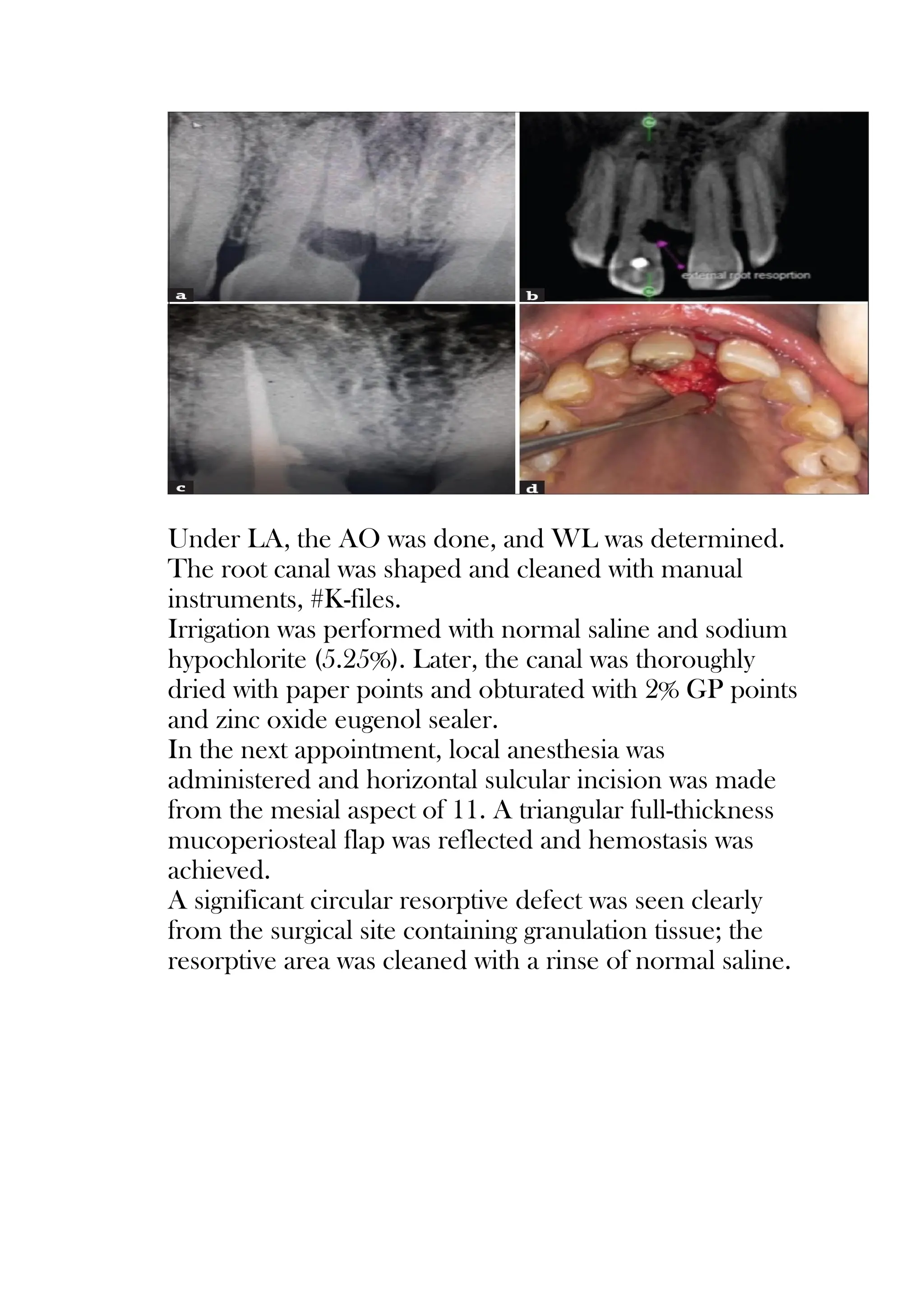 JC 2 ECR external cervical resorption in adult tooth | DOCX