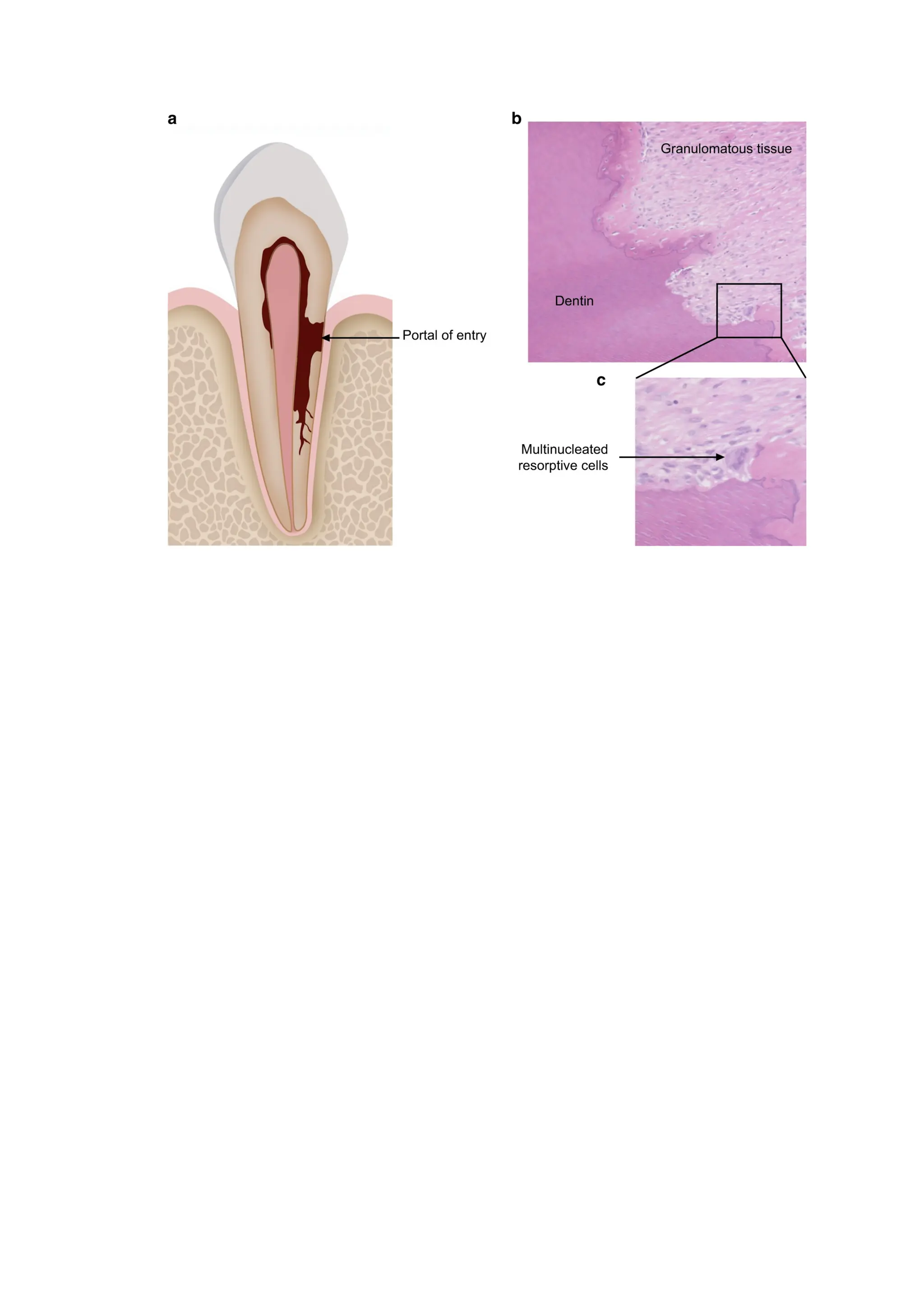 JC 2 ECR external cervical resorption in adult tooth | DOCX