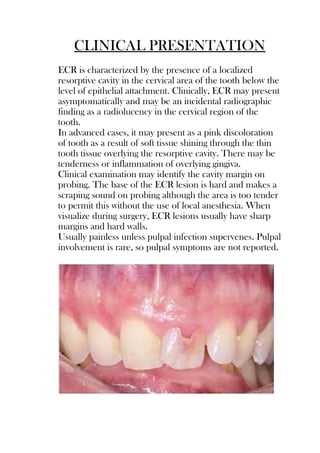 JC 2 ECR external cervical resorption in adult tooth | DOCX