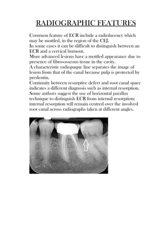 JC 2 ECR external cervical resorption in adult tooth | DOCX