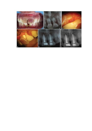 JC 2 ECR external cervical resorption in adult tooth | DOCX