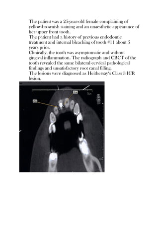 JC 2 ECR external cervical resorption in adult tooth | DOCX
