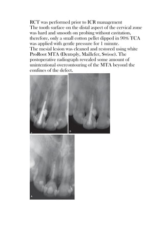 JC 2 ECR external cervical resorption in adult tooth | DOCX