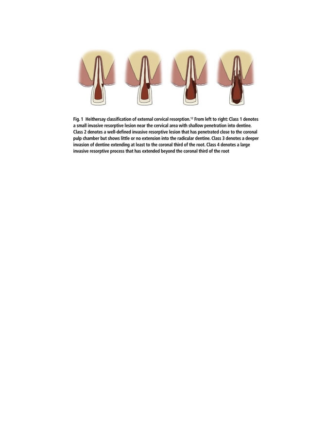 JC 2 ECR external cervical resorption in adult tooth | PDF | Free Download