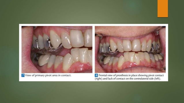 Prosthodontics Journal Club: Management pf a partially edentulous ...