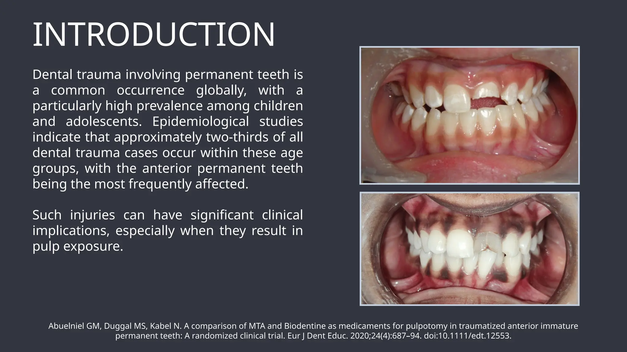 Comparison of MTA and Biodentine as Medicaments for pulpotomy in ...