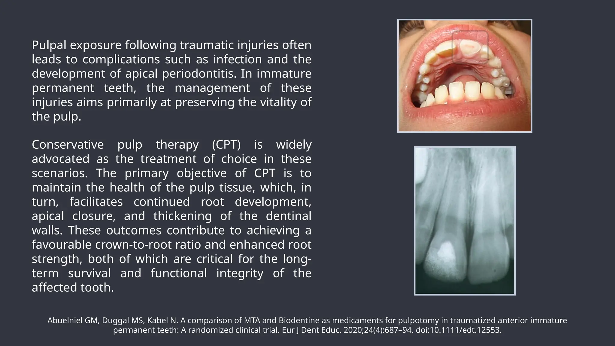 Comparison of MTA and Biodentine as Medicaments for pulpotomy in ...