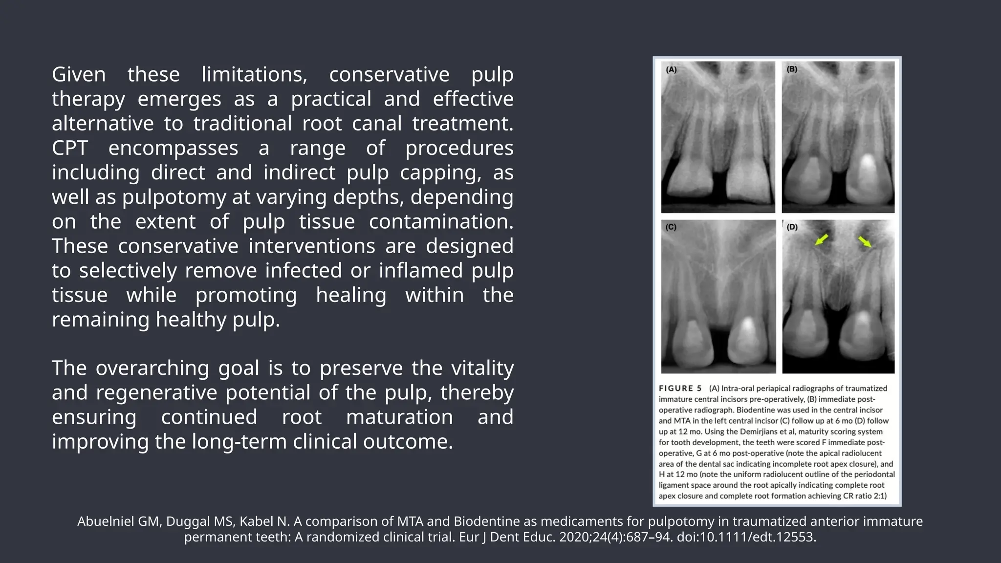 Comparison of MTA and Biodentine as Medicaments for pulpotomy in ...