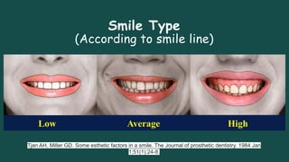 Journal club on gummy smile presentation.pptx