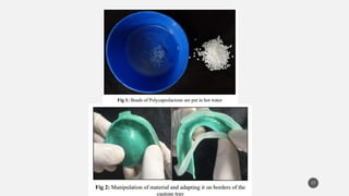 modified technique for single step border molding.pptx