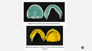 modified technique for single step border molding.pptx