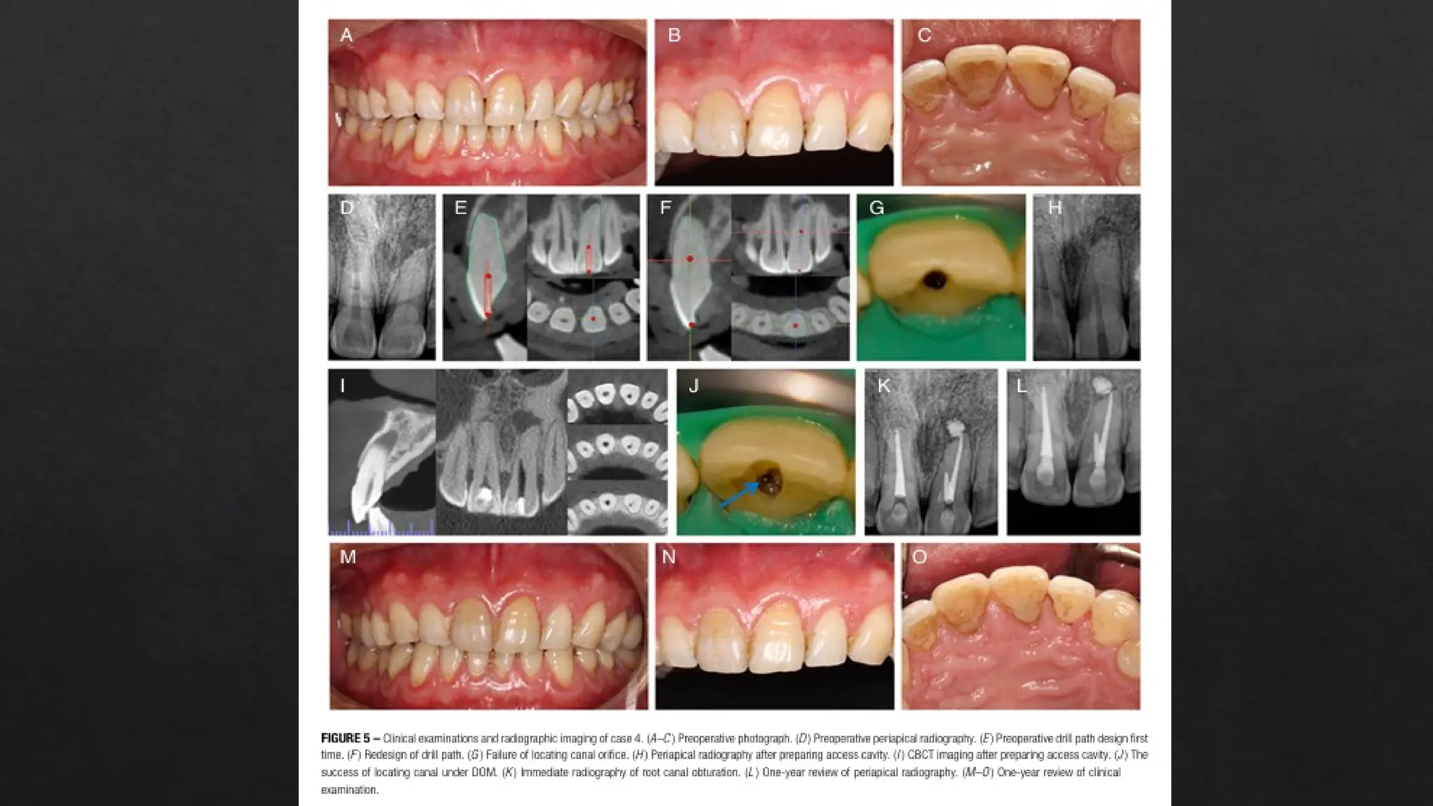 LIMITATION AND MANAGEMENT OF DYNEMIC SYSTEM FOR LOCATING CALCIFIED CANALYNEMIC NAVIGATION SYSTEM ...