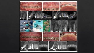 LIMITATION AND MANAGEMENT OF DYNEMIC SYSTEM FOR LOCATING CALCIFIED CANALYNEMIC NAVIGATION SYSTEM ...