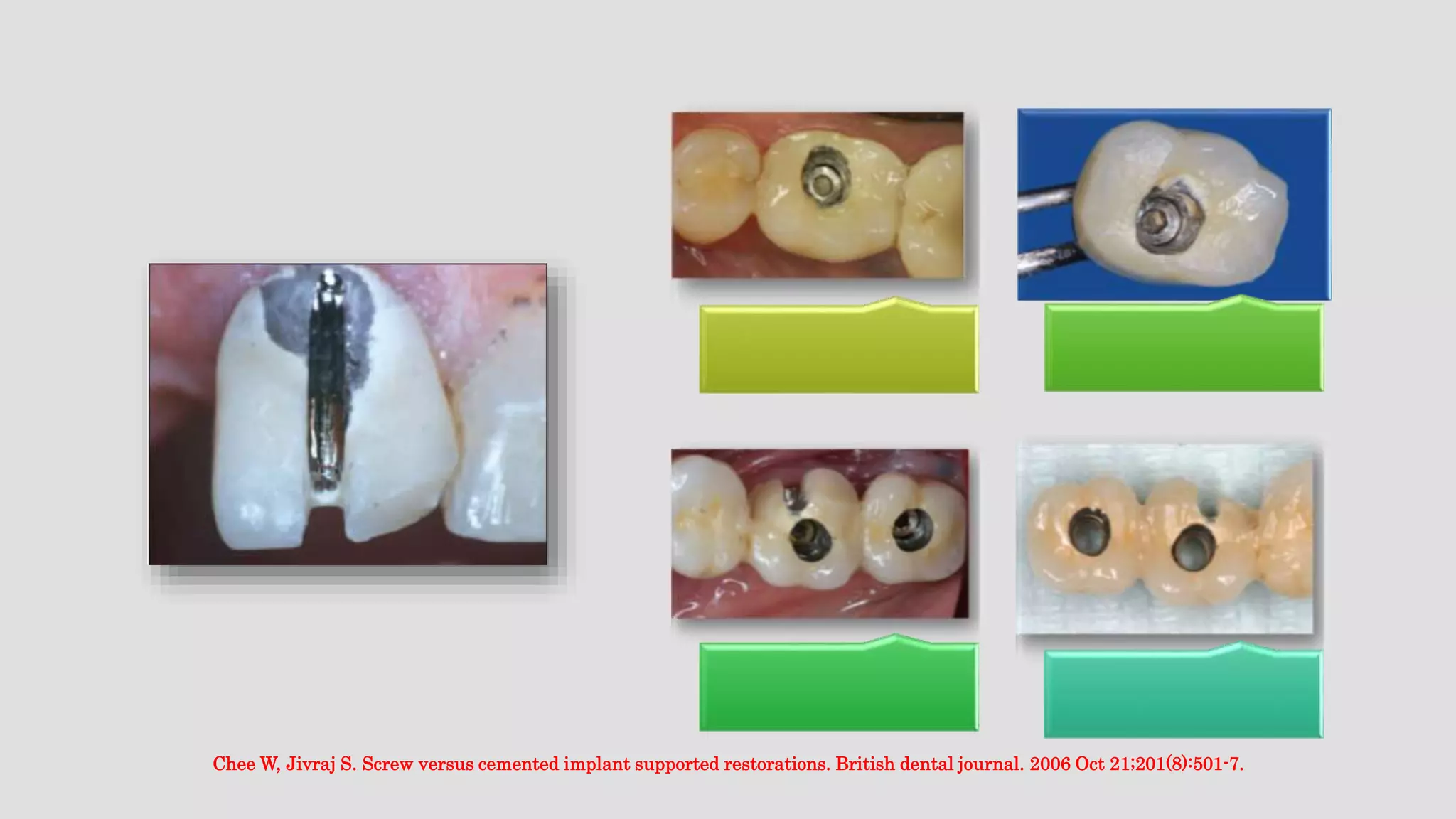 Screw vs cement retained implant prosthesis | PPTX