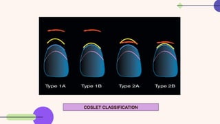 JC 4. On computer guided gingivectomy device | PPTX