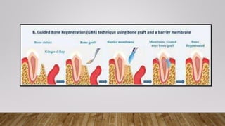 bone grafts and substitutes | PPTX