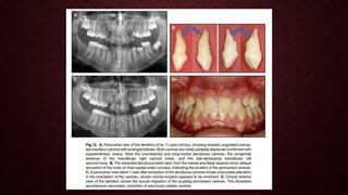 JC(5) Diagnosis and Management of Maxillary Impacted Canines.pptx