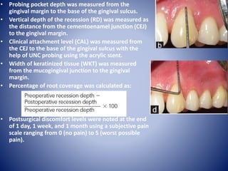 Multiple Gingival Recession Defects | PPTX