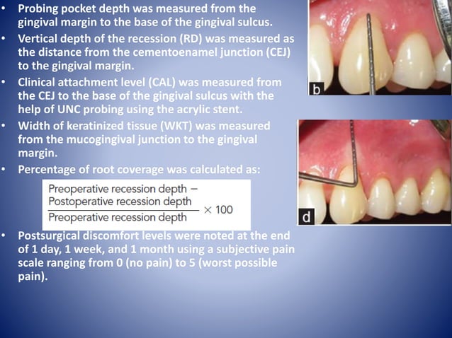 Multiple Gingival Recession Defects | PPTX