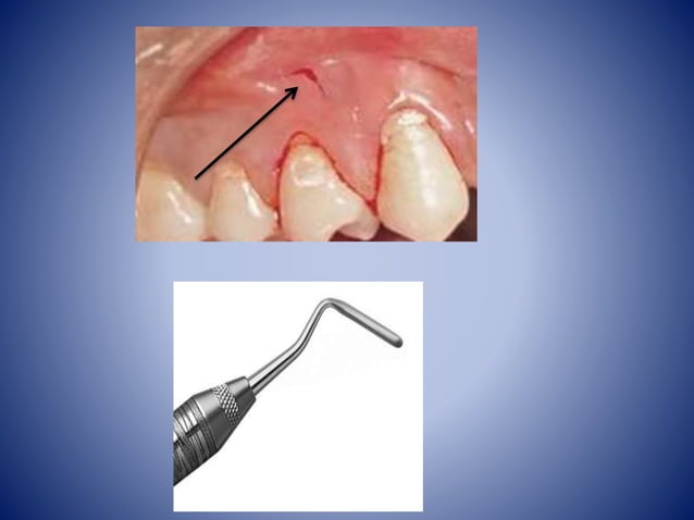 Multiple Gingival Recession Defects | PPTX