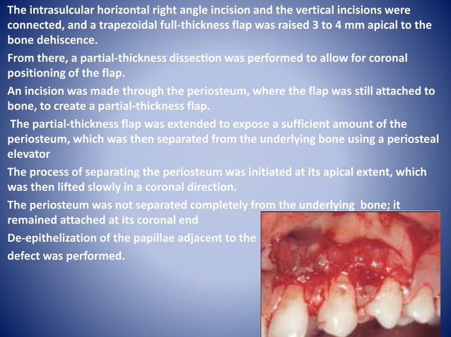 Multiple Gingival Recession Defects | PPTX