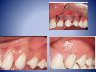 Multiple Gingival Recession Defects | PPTX