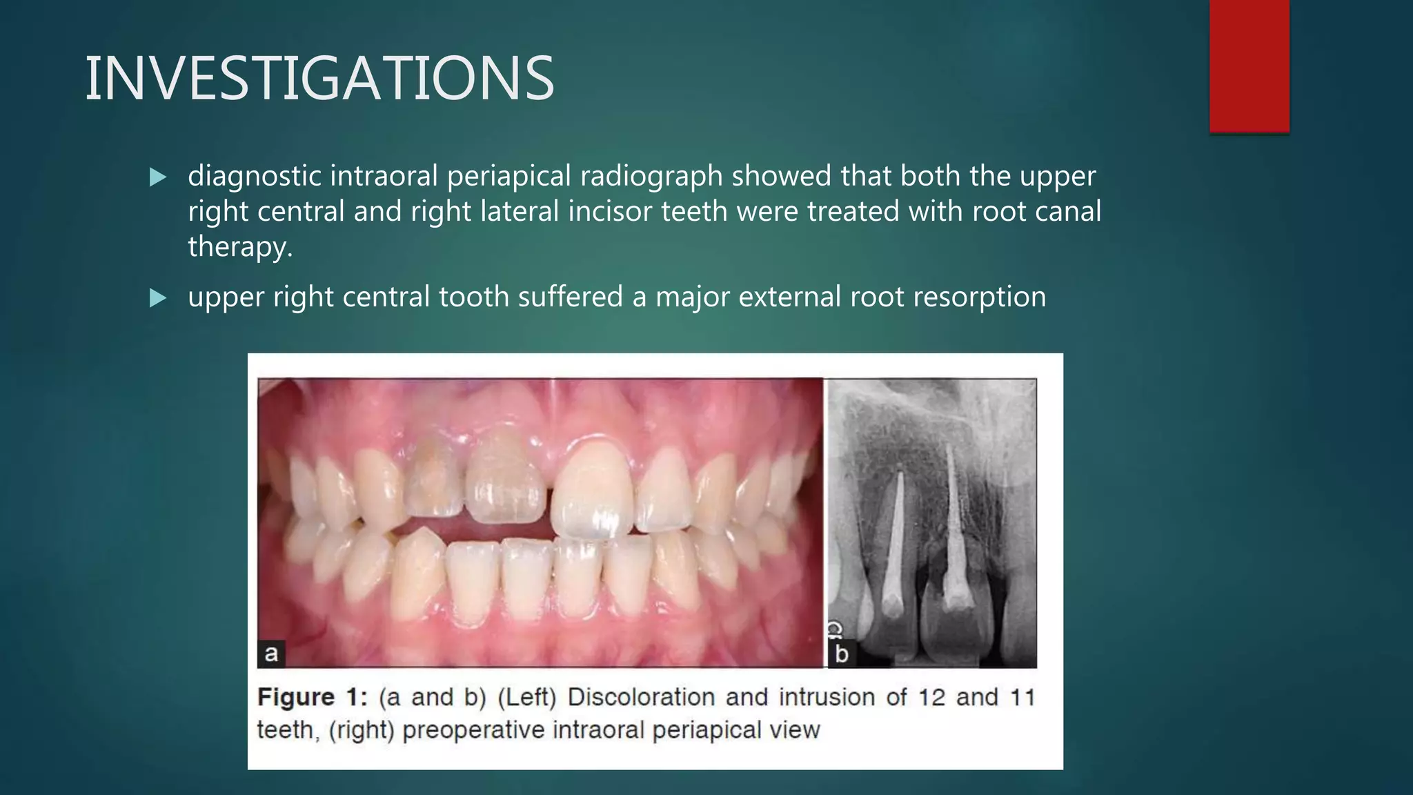 JOURNAL CLUB PRESENTATION IN PROSTHODONTICS ON PLATELET RICH FACTOR | PPTX