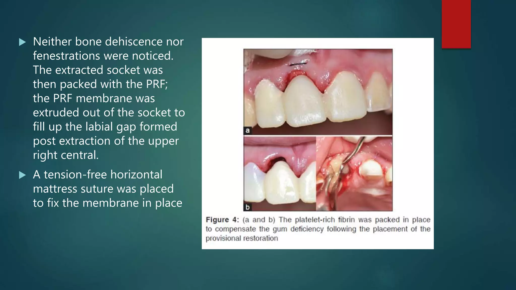 JOURNAL CLUB PRESENTATION IN PROSTHODONTICS ON PLATELET RICH FACTOR | PPTX