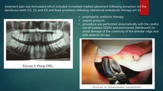 JOURNAL CLUB PRESENTATION IN PROSTHODONTICS ON PLATELET RICH FACTOR | PPTX