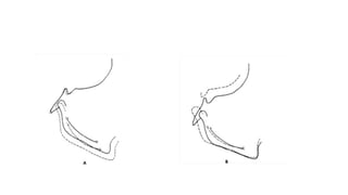 The Primary role of functional matrices in facial growth- Moss ...