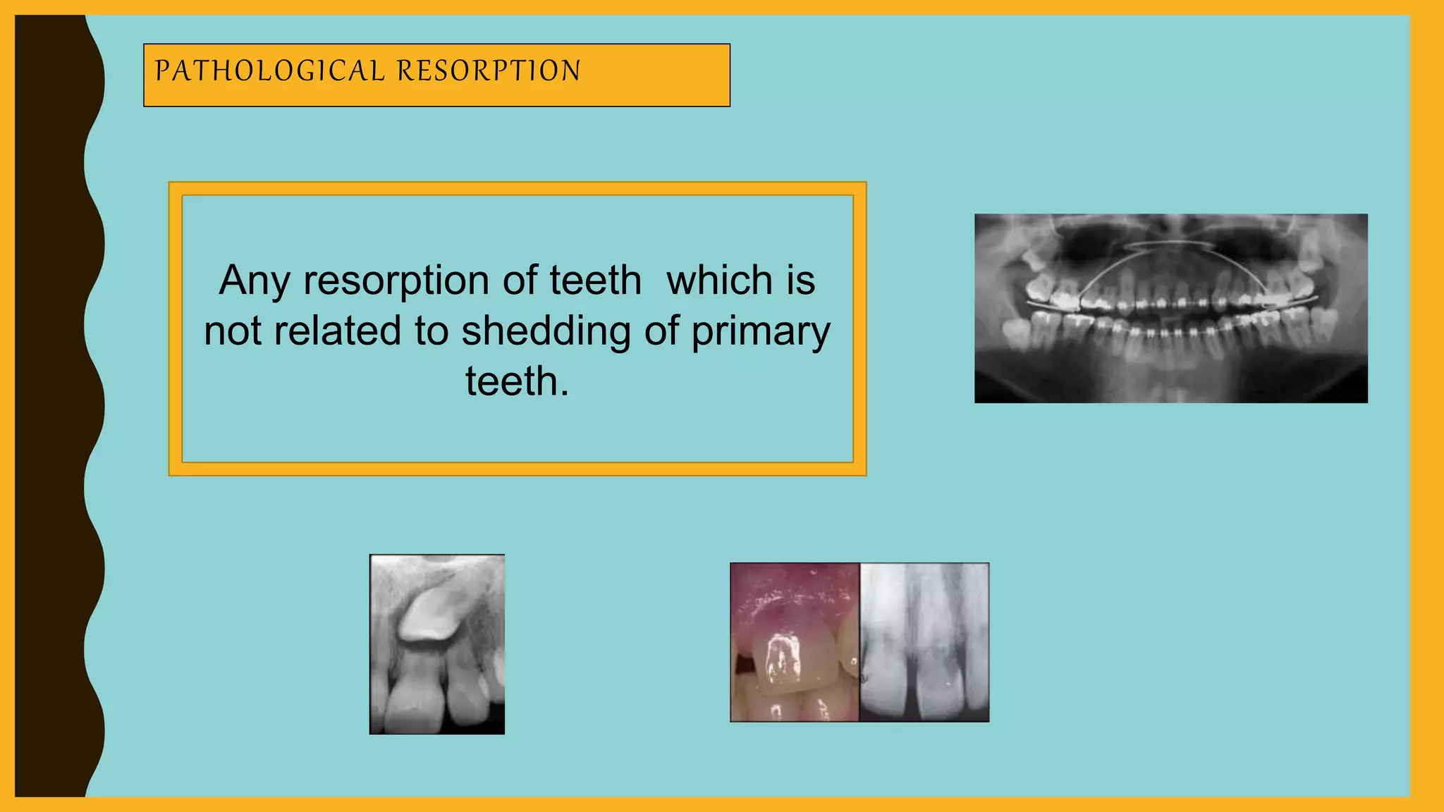 multiple idiopathic external and internal resorption- Dr Sanjana ...
