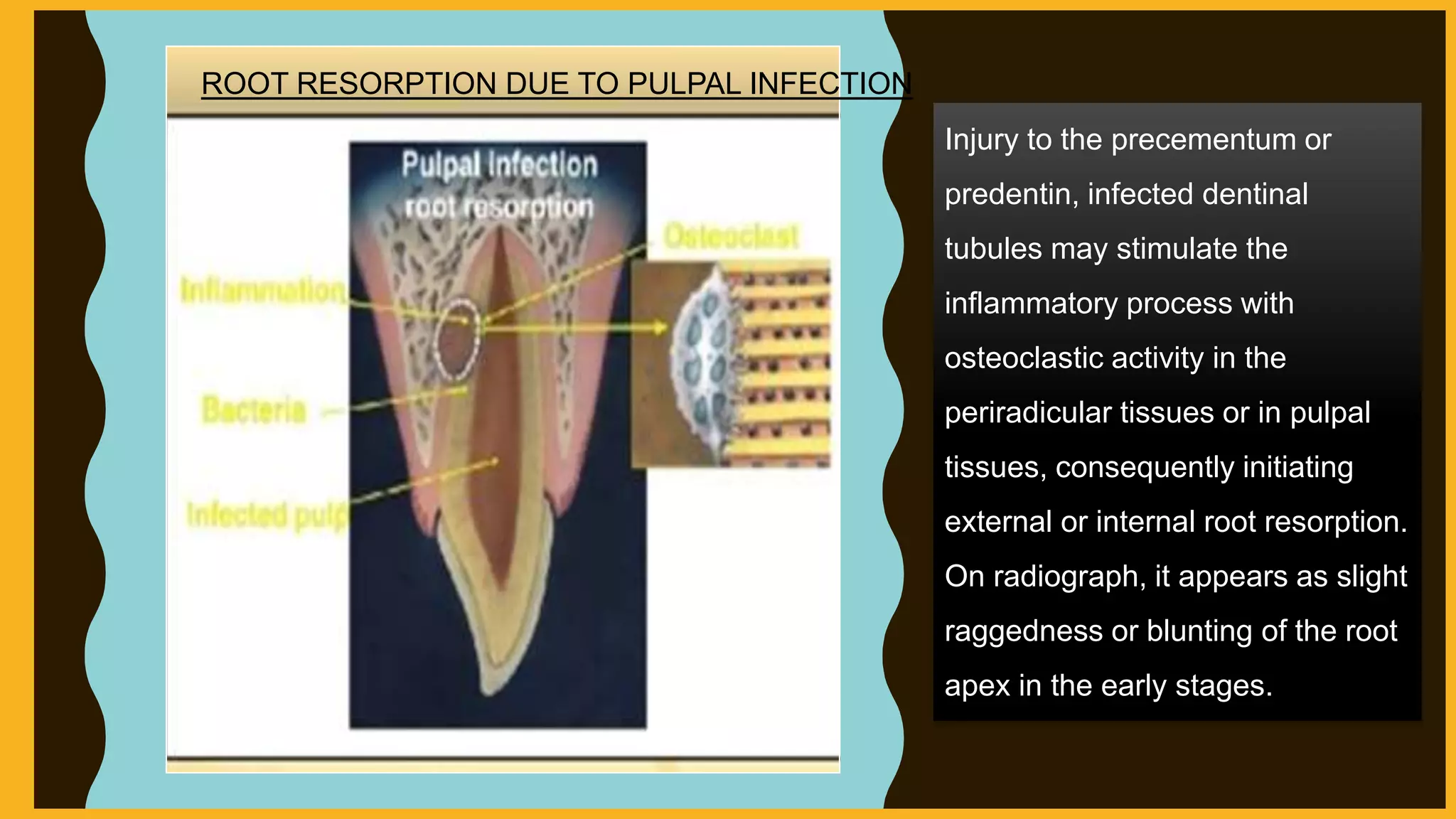 multiple idiopathic external and internal resorption- Dr Sanjana ...