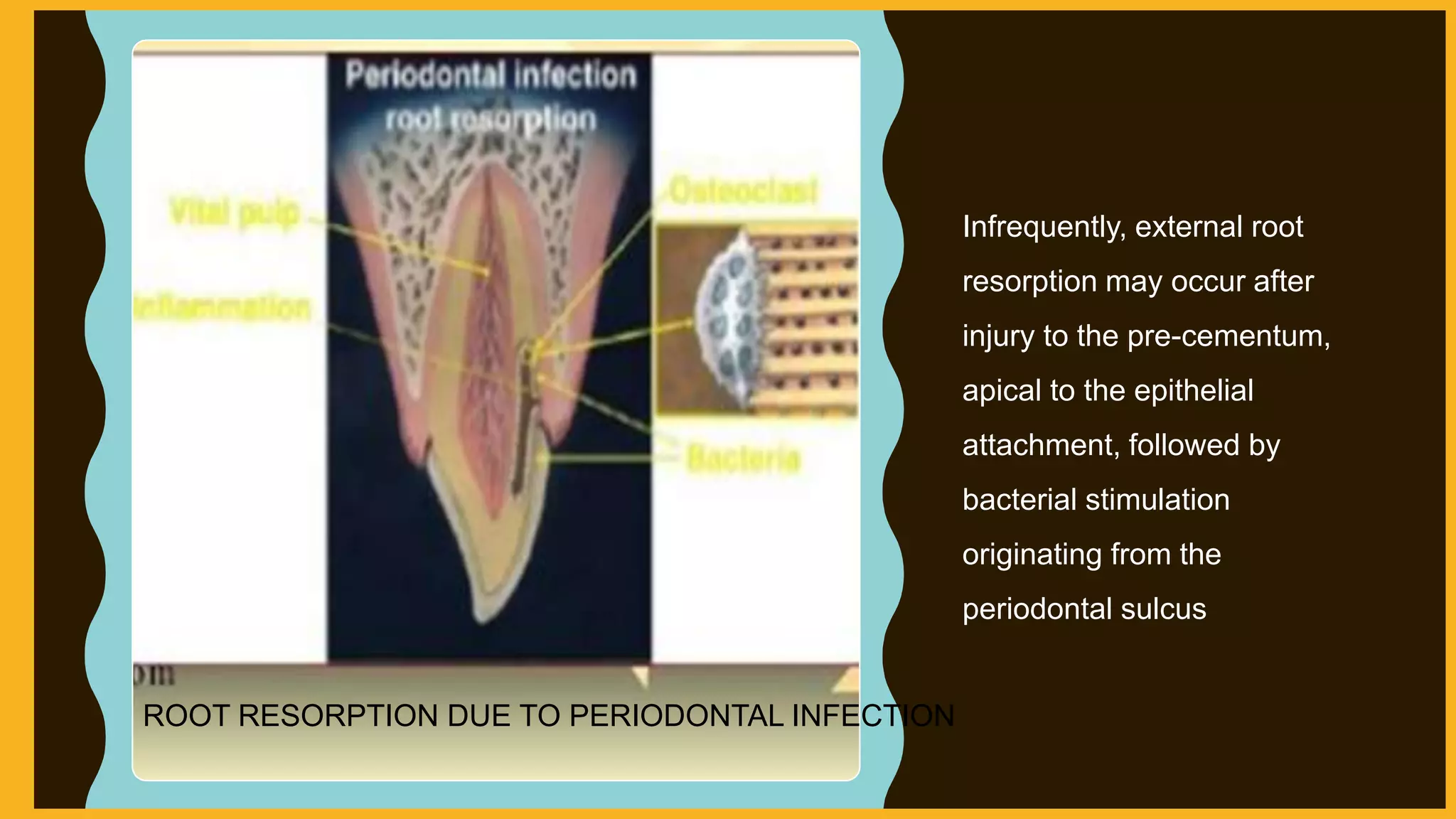 multiple idiopathic external and internal resorption- Dr Sanjana ...