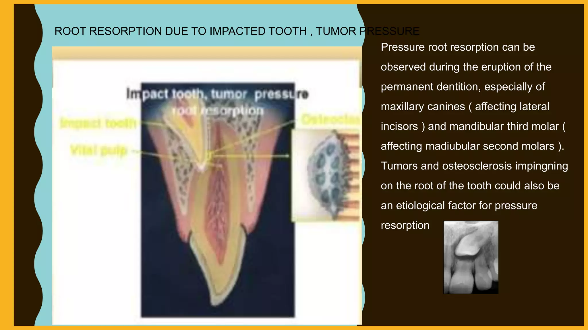 multiple idiopathic external and internal resorption- Dr Sanjana ...