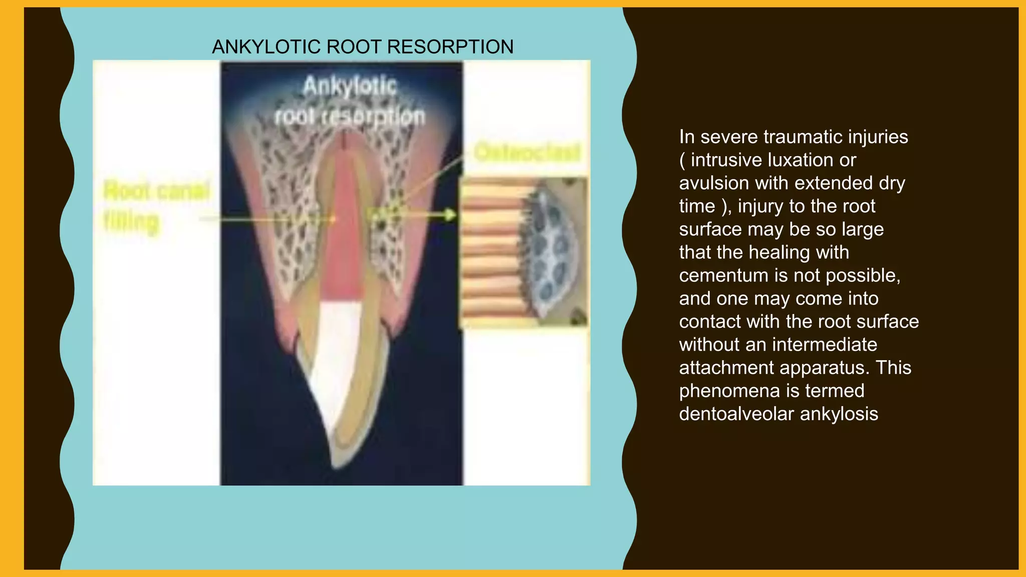 multiple idiopathic external and internal resorption- Dr Sanjana ...