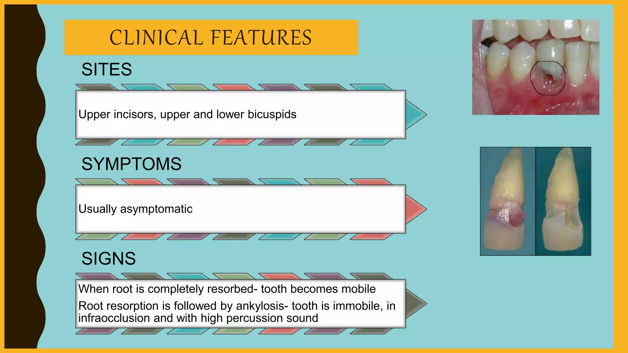 multiple idiopathic external and internal resorption- Dr Sanjana ...