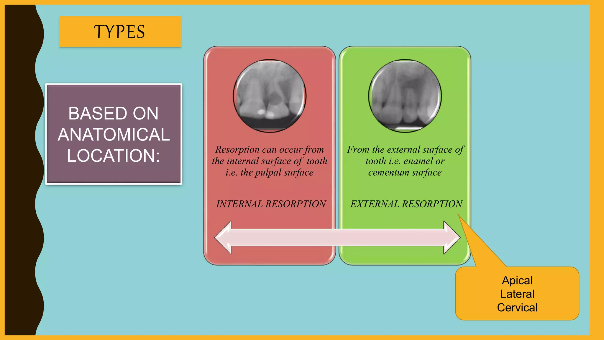 multiple idiopathic external and internal resorption- Dr Sanjana ...