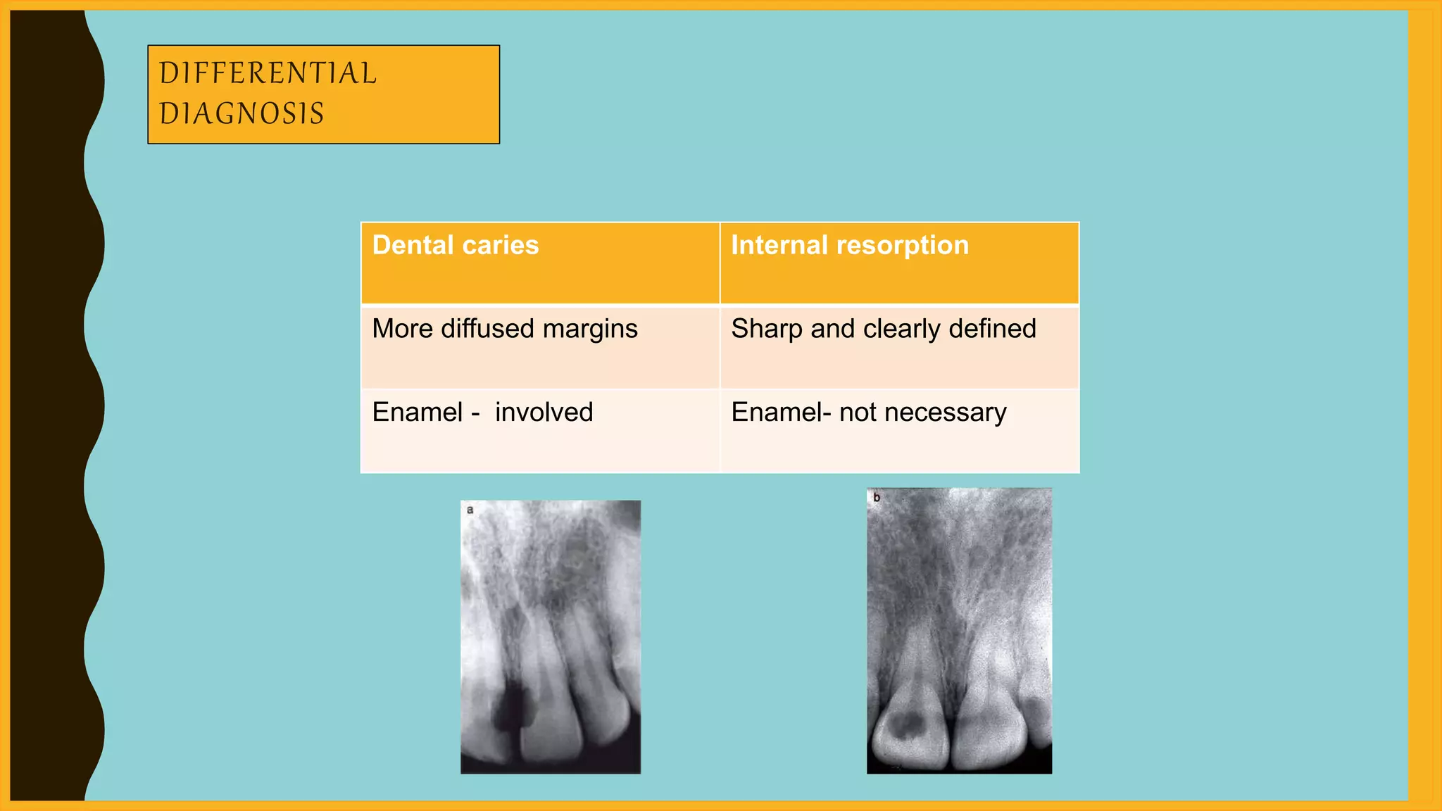 multiple idiopathic external and internal resorption- Dr Sanjana ...