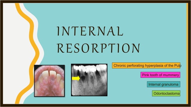 multiple idiopathic external and internal resorption- Dr Sanjana ...