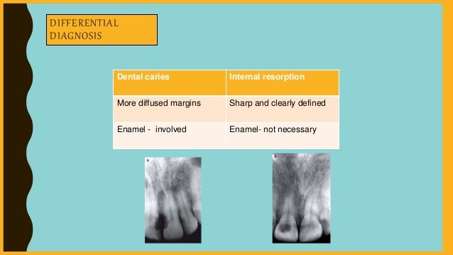 multiple idiopathic external and internal resorption- Dr Sanjana Ravi…