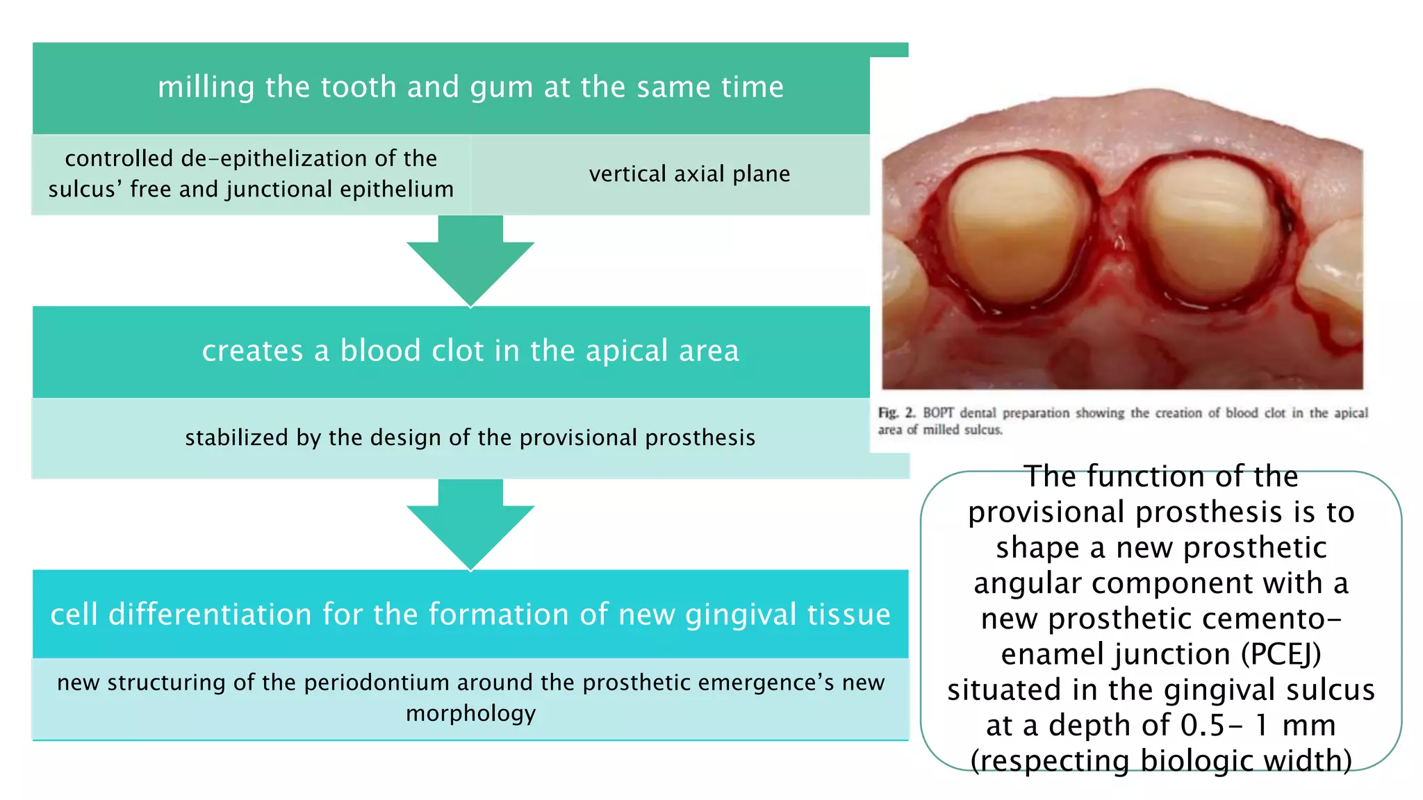 JOURNAL CLUB PRESENTATION IN PROSTHODONTICS on biologically oriented ...