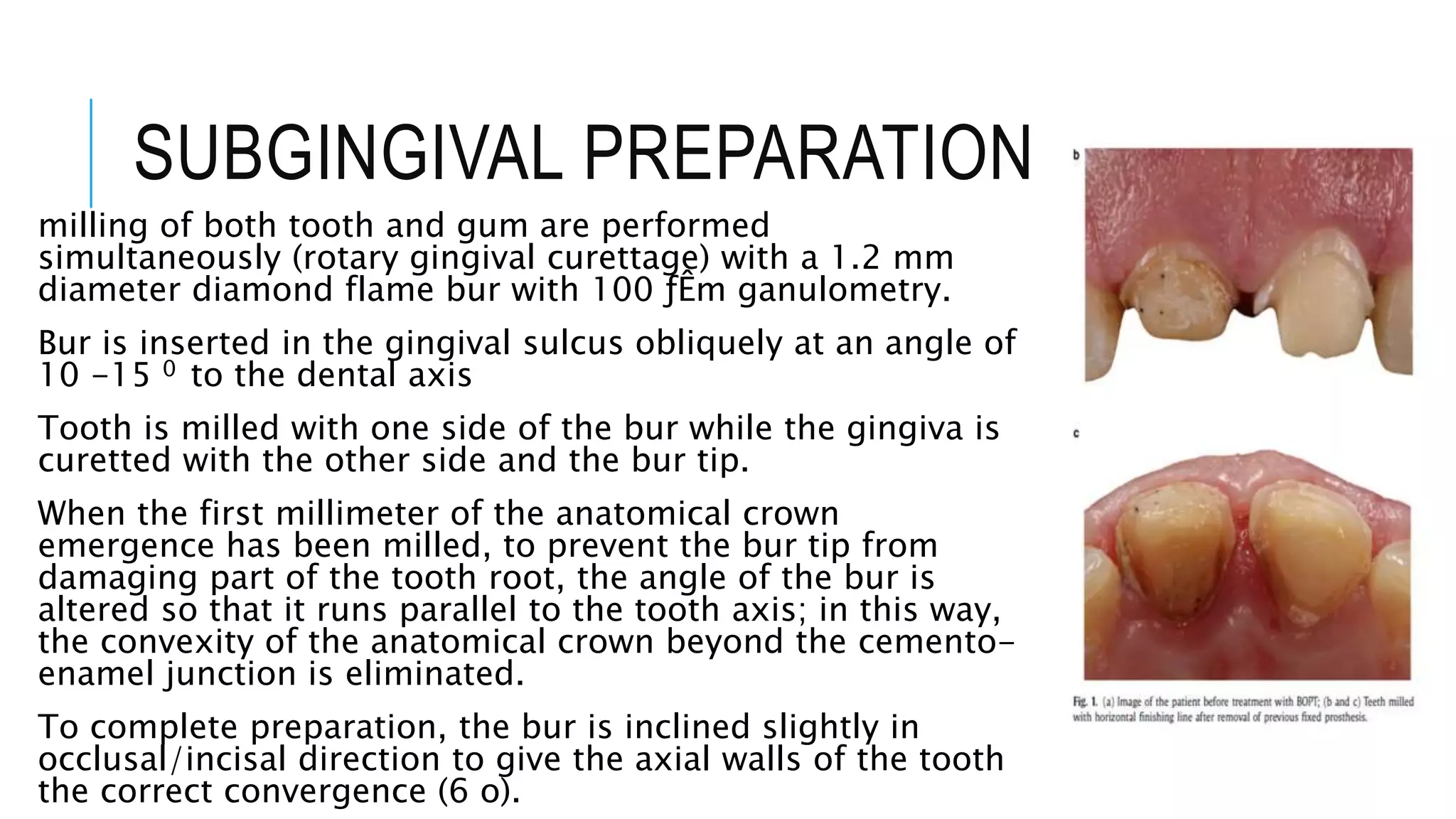 JOURNAL CLUB PRESENTATION IN PROSTHODONTICS on biologically oriented ...