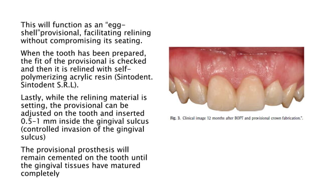 JOURNAL CLUB PRESENTATION IN PROSTHODONTICS on biologically oriented ...