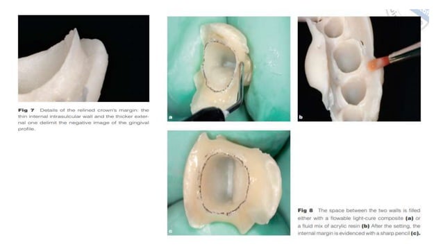 JOURNAL CLUB PRESENTATION IN PROSTHODONTICS on biologically oriented ...