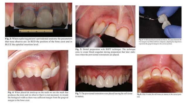 JOURNAL CLUB PRESENTATION IN PROSTHODONTICS on biologically oriented ...