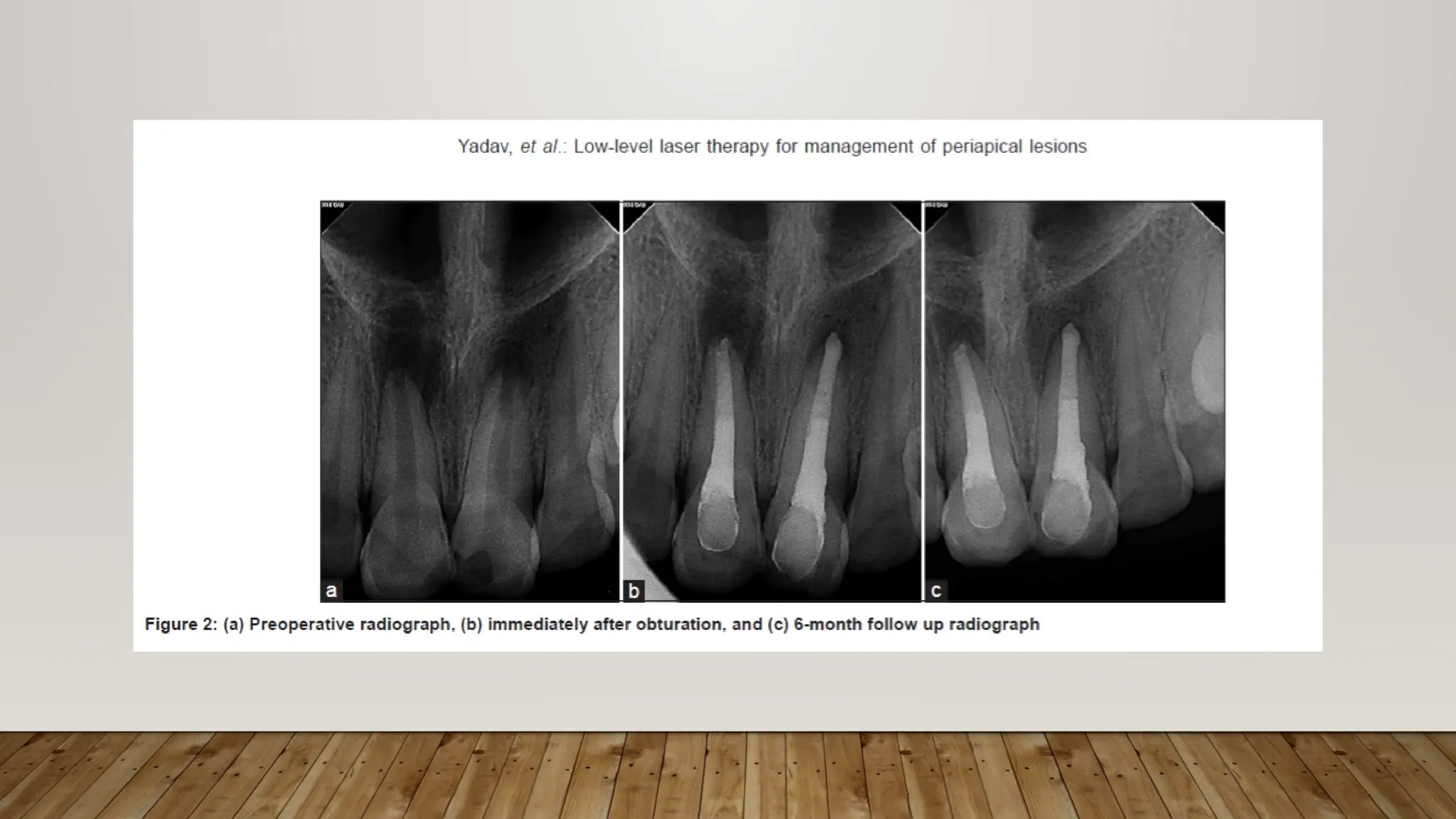 low level laser therapy for management for apical lesions | PPT