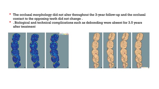 Monolithic zirconia crown with rigid and non rigid connectors | PPTX ...