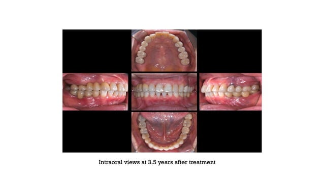 Monolithic zirconia crown with rigid and non rigid connectors | PPTX ...