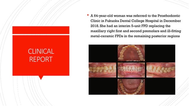 Monolithic zirconia crown with rigid and non rigid connectors | PPTX ...