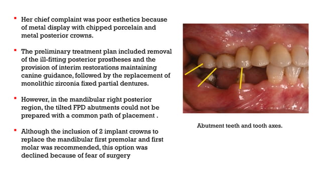 Monolithic zirconia crown with rigid and non rigid connectors | PPTX ...